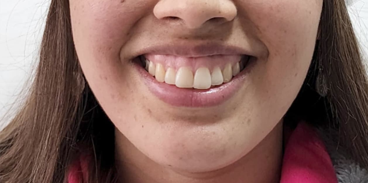 ELITOX® — Premium Botulinum Toxin for Safe and Effective Wrinkle ...