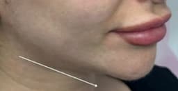 Lipo Lax® — Effective Lipolytic Solution for Fat Reduction | KORU Pharma