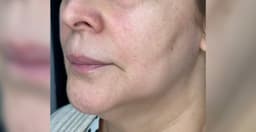 Lipo Lax® — Effective Lipolytic Solution for Fat Reduction | KORU Pharma